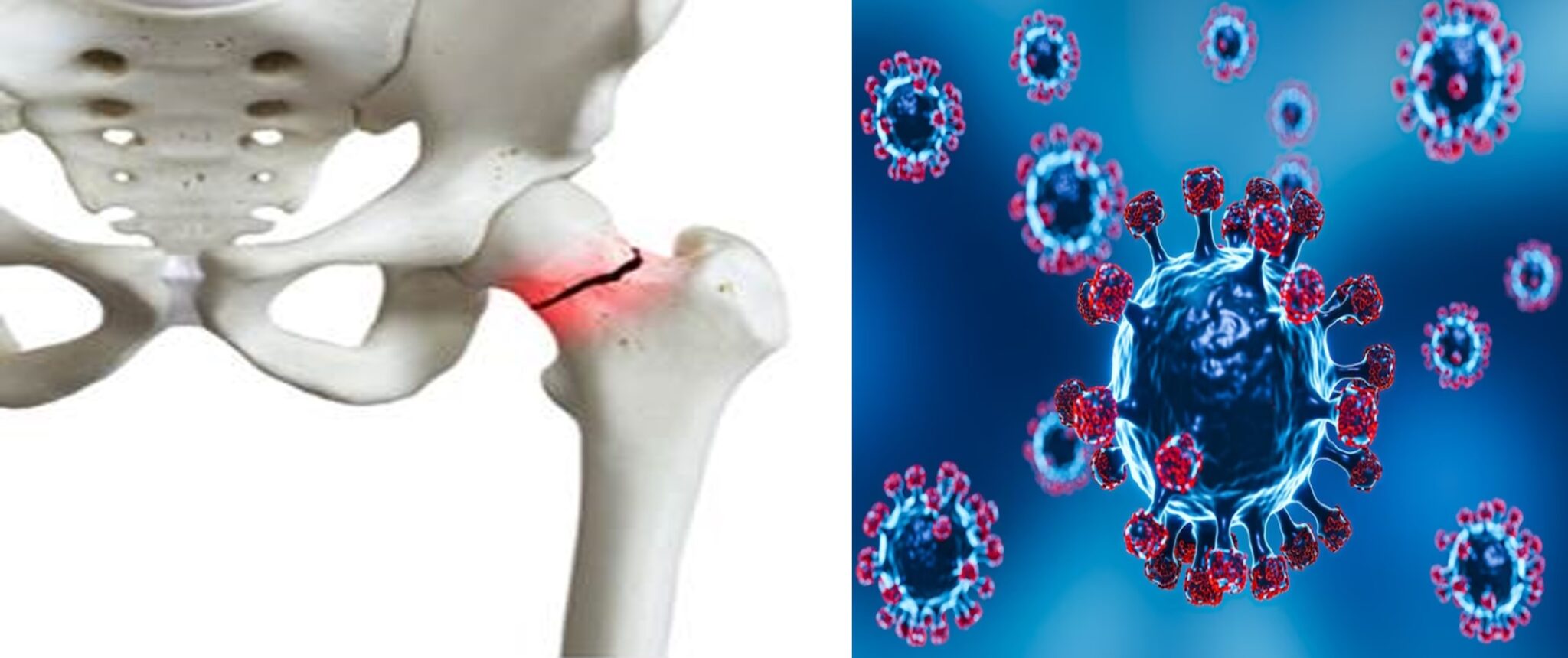 Was it a Pyrrhic Victory? Mortality and outcomes in fragility fracture ...
